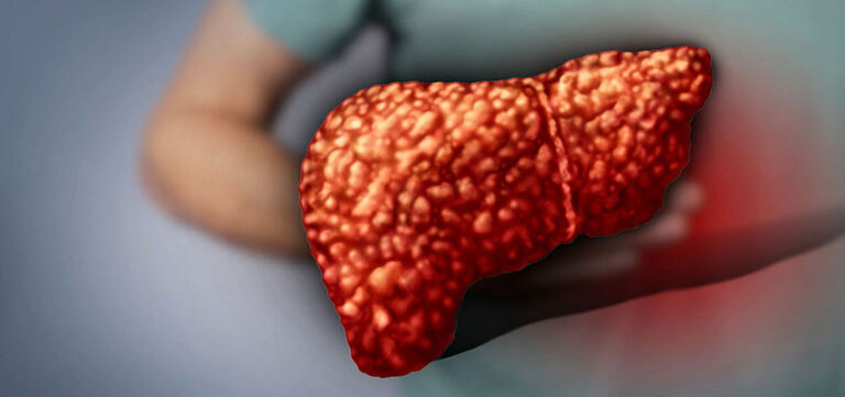 Grade 2 Fatty Liver: Symptoms, Risks, and Treatment Options - PlanMyMedical