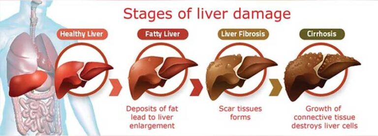Grade 2 Fatty Liver: Symptoms, Risks, and Treatment Options - PlanMyMedical