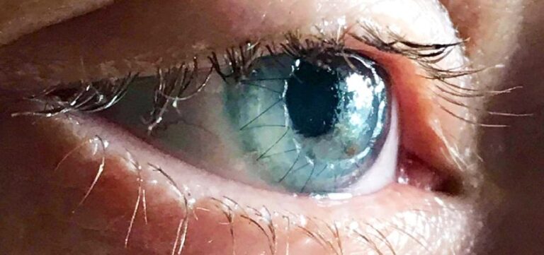 Eye Transplant Cost in India from Best Doctor